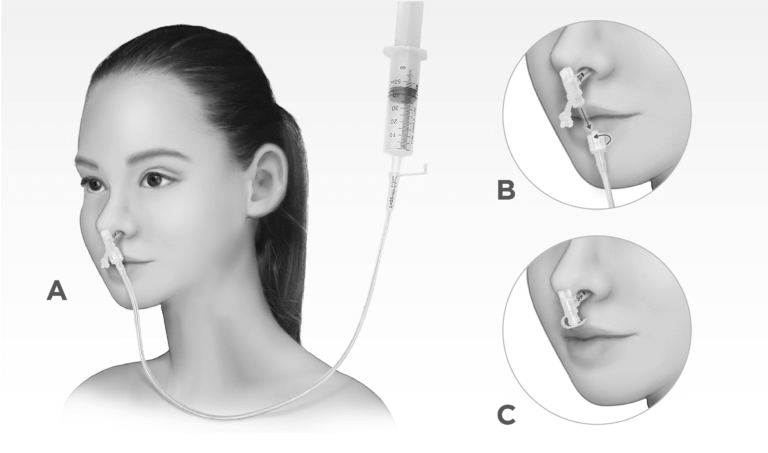 Silicone Gastric Tube, Detachable Type – Fortune Medical Instrument Corp.